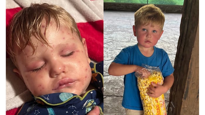 Georgia Toddler Stung Over 150 Times by Wasps Battles Recovery ...