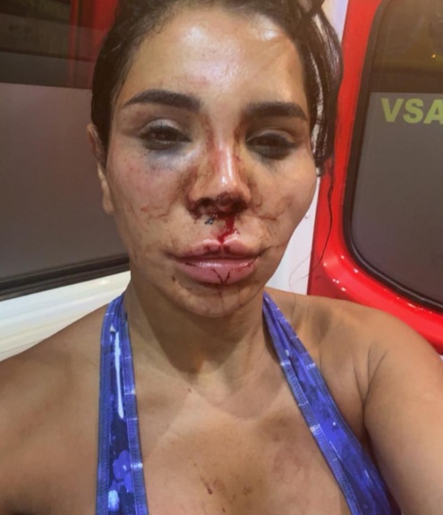 Beauty Influencer Left 'Disfigured' Following Terrifying Home Invasion ...