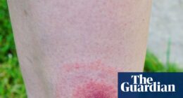 England Sees Over 20% Surge in Lyme Disease Cases: Urgent Public Health ...