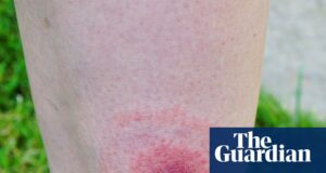 England Sees Over 20% Surge in Lyme Disease Cases: Urgent Public Health ...