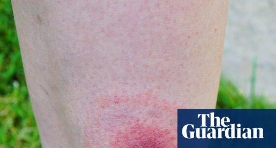 England Sees Over 20% Surge in Lyme Disease Cases: Urgent Public Health ...